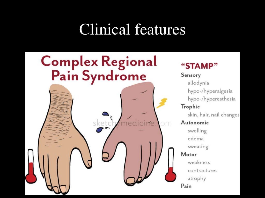Recent advances in crps (Physiotherapy perspective)