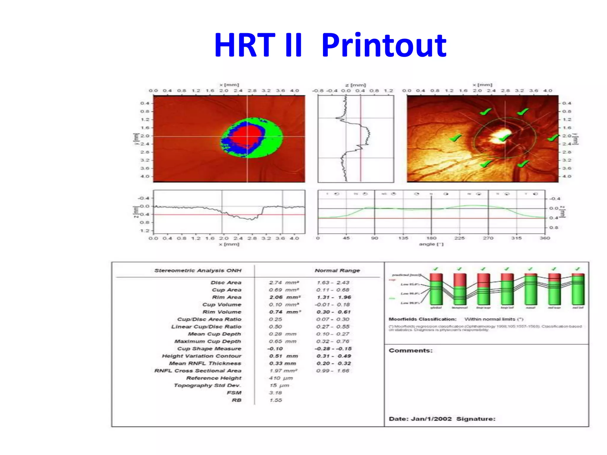 Recent advances in diagnosis of glaucoma | PPTX