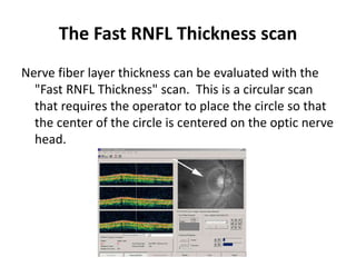Recent advances in diagnosis of glaucoma | PPTX