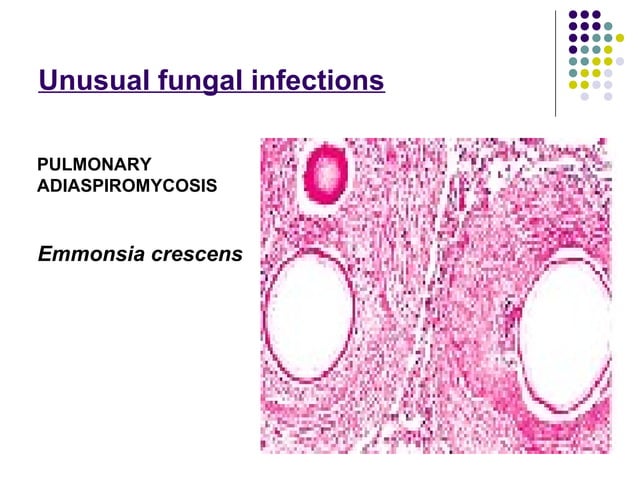 Recent advances in fungal infections | PPT