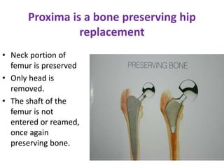 Recent advances in joint arthroplasty | PPTX