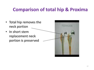 Recent advances in joint arthroplasty | PPTX