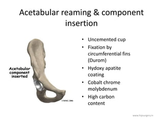 Recent advances in joint arthroplasty | PPTX