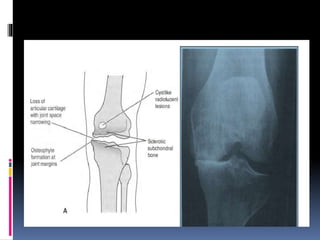 Recent advances in knee oa | PPTX