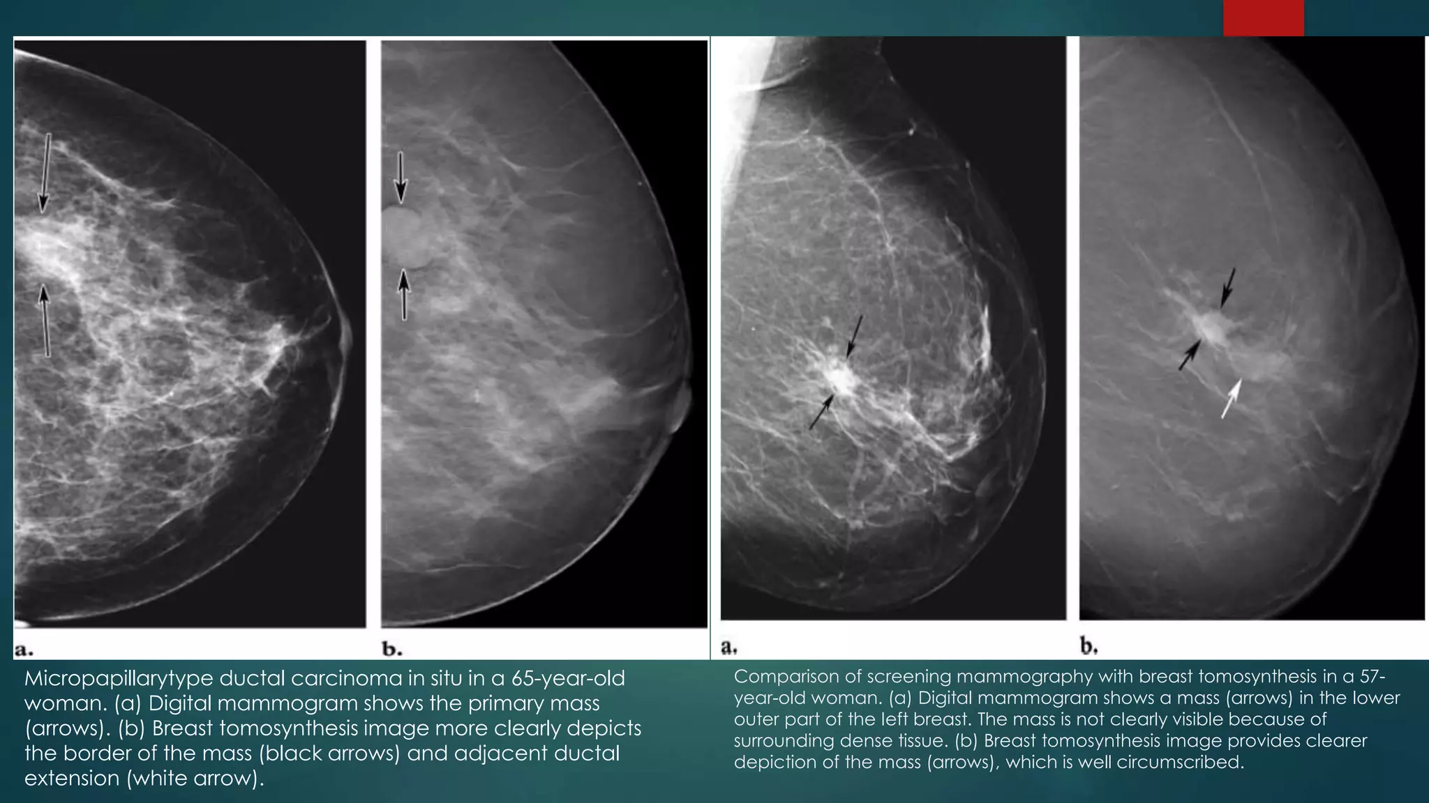 Recent advances in Mammography | PPTX