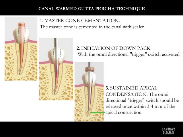 Recent advances in obturation techniques/ dental implant courses