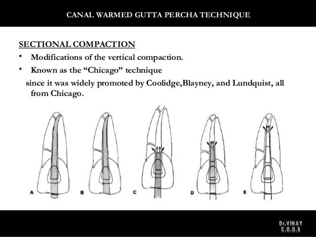 Recent advances in obturation techniques/ dental implant courses