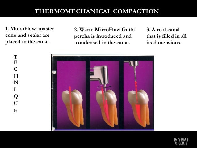Recent advances in obturation techniques/ dental implant courses