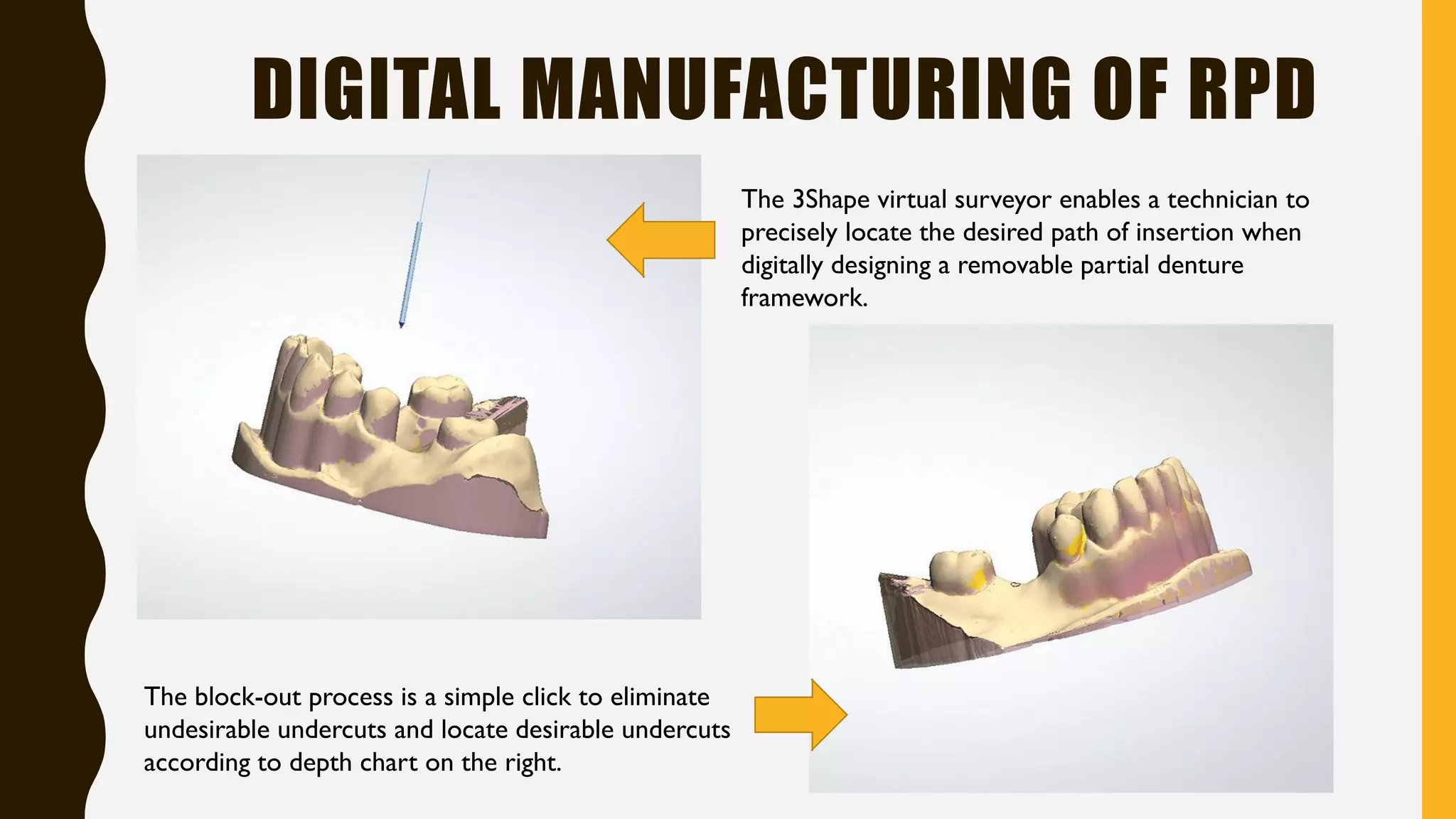 RECENT ADVANCES IN REMOVABLE PARTIAL DENTURES | PDF
