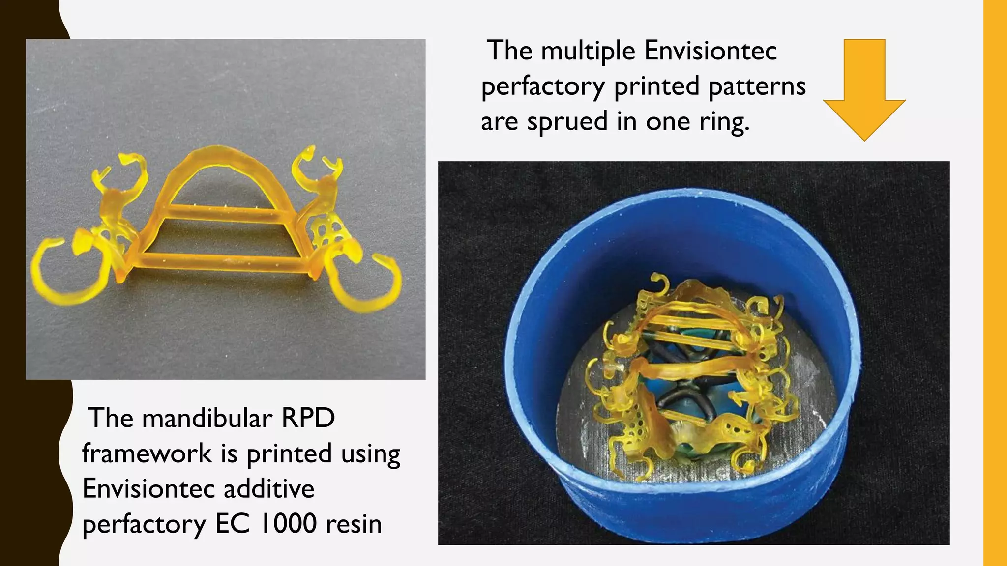 RECENT ADVANCES IN REMOVABLE PARTIAL DENTURES | PDF