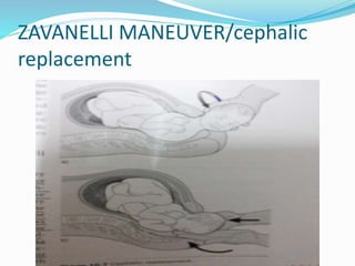 Recent advances in shoulder dystocia ppt | PPTX