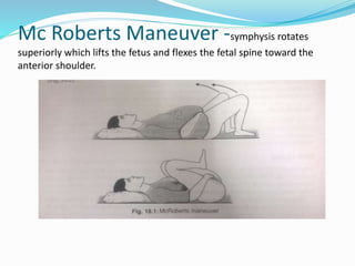 Recent advances in shoulder dystocia ppt | PPT