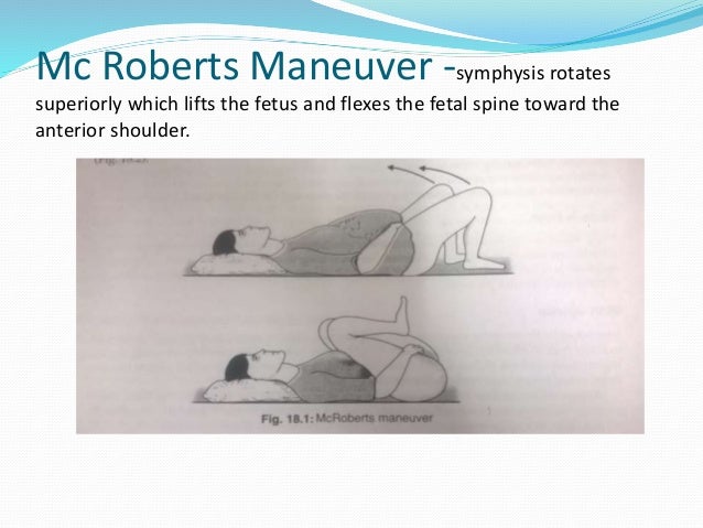 Recent advances in shoulder dystocia ppt