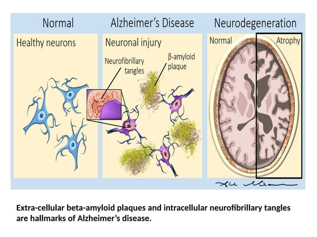 RECENT ADVANCES IN THE PHARMACOTHERAPY OF ALZHEIMER’S DISEASE.pptx