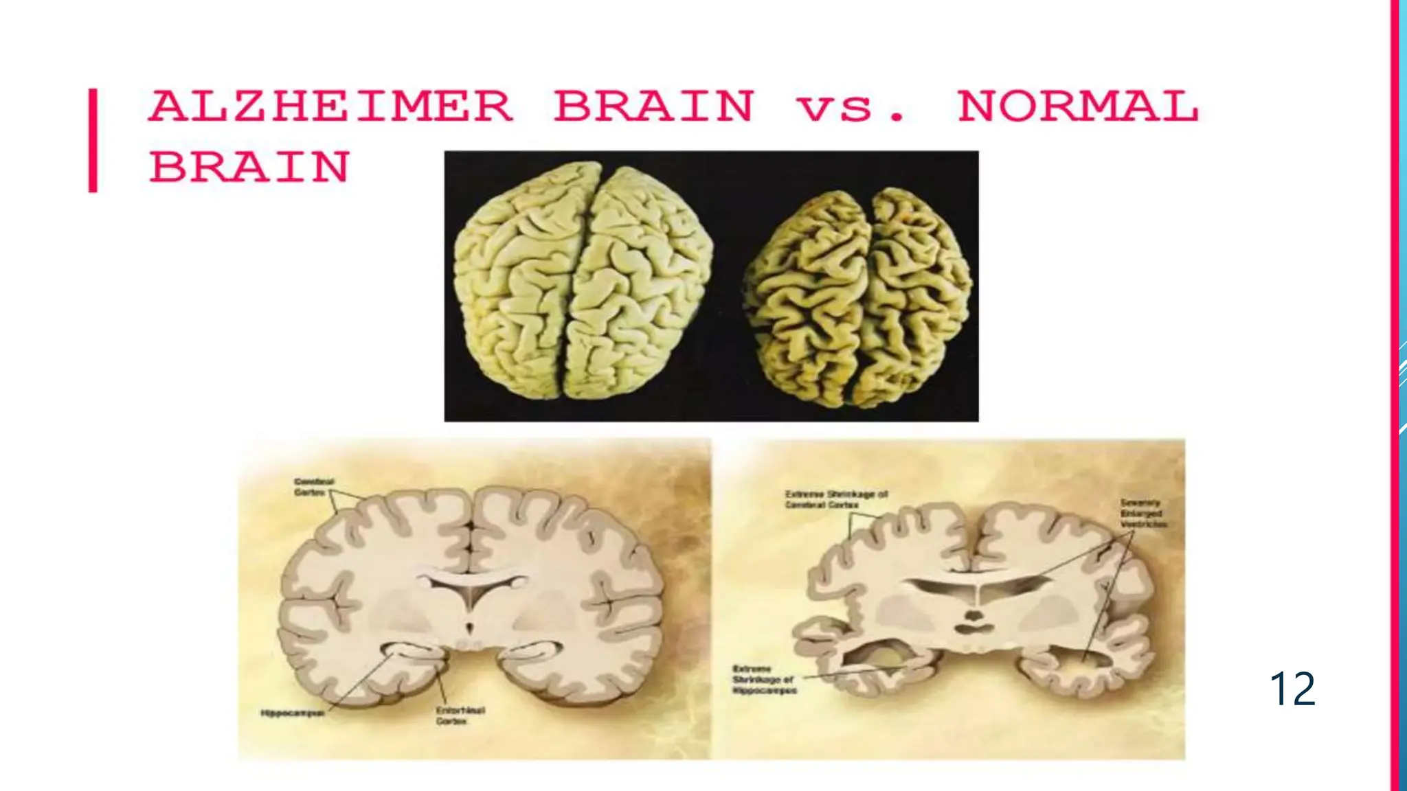 recent advances in the treatment of alzheimers disease.pptx
