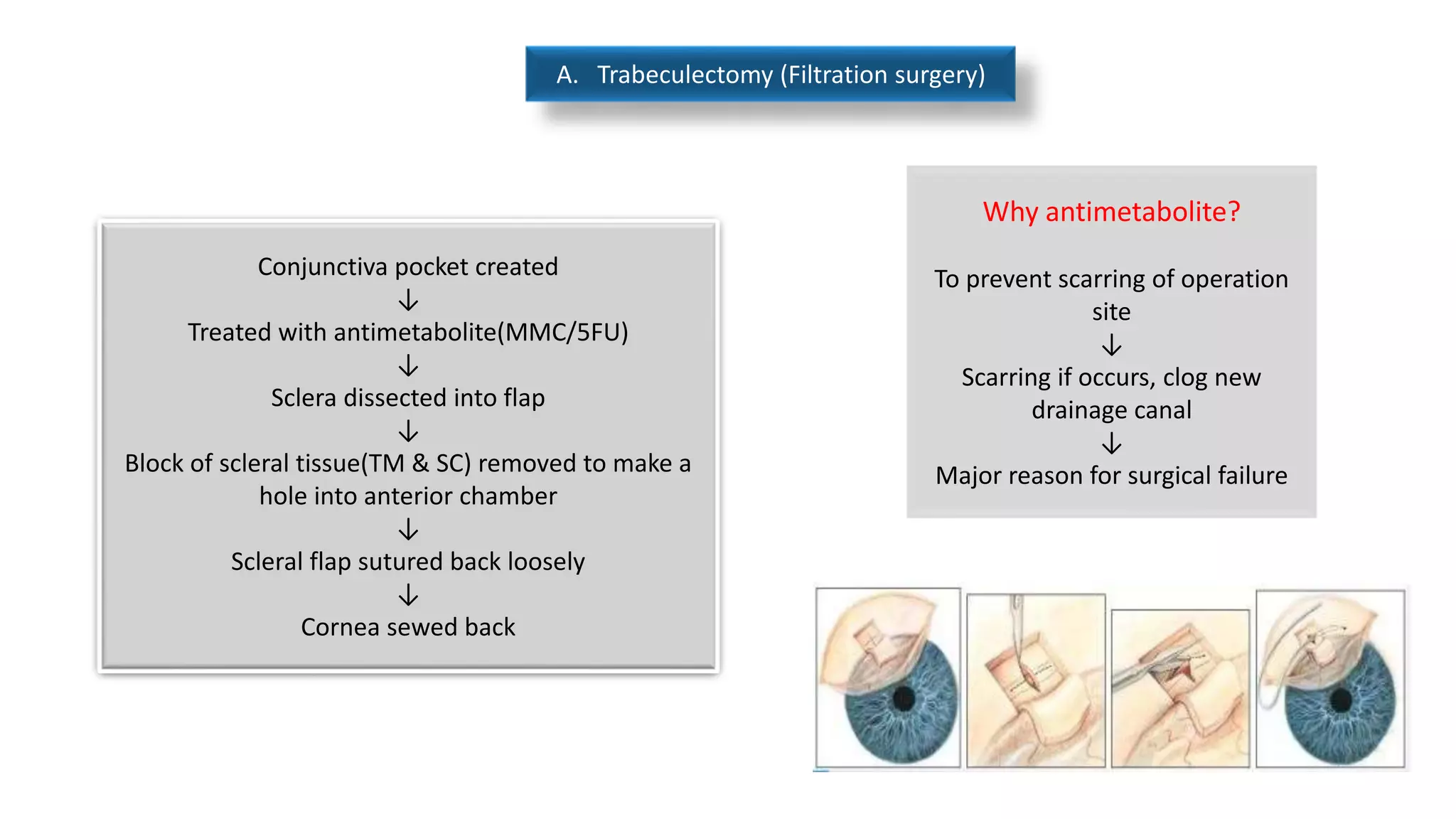 Recent advances in the treatment of glaucoma.pptx