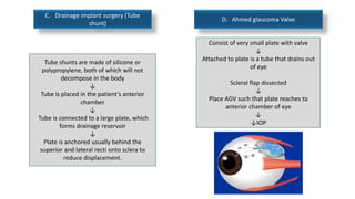 Recent advances in the treatment of glaucoma.pptx
