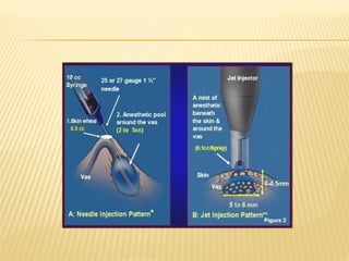 Recent Advances in local Anaesthesia in dentistry | PPT