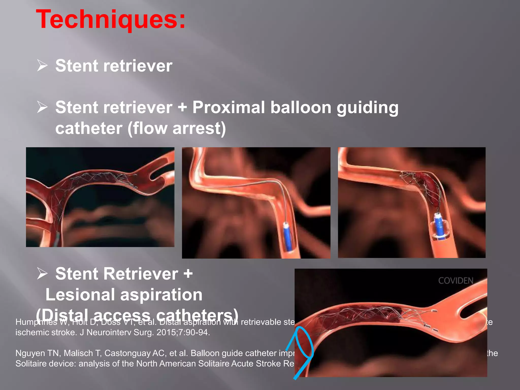 Recent evidence for mechanical thrombolysis | PDF