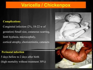 Chorioretinitis Neonate