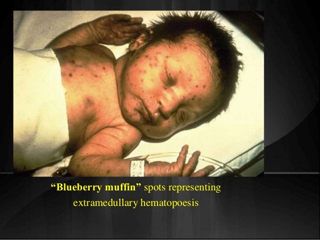 Congenital Rubella Blueberry Muffin Rash