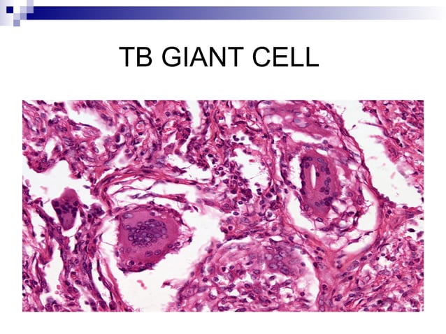recent in T.B diagnosis of tuberculosis path | PPT