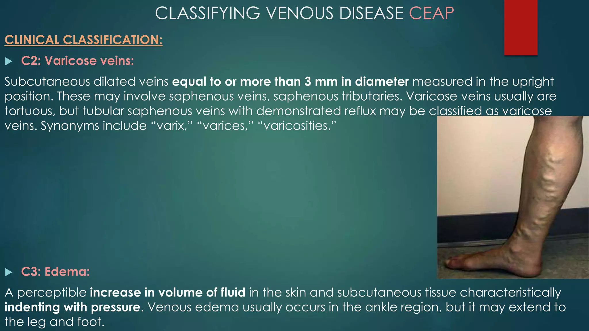 Recent management of primary varicose veins | PPTX