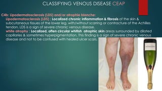 Recent management of primary varicose veins | PPTX