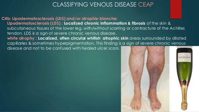 Recent management of primary varicose veins