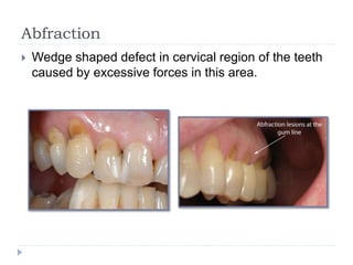 Recent Methodology in Management of Non-carious Lesions | PPTX