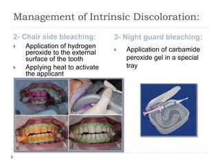 Recent Methodology in Management of Non-carious Lesions | PPTX