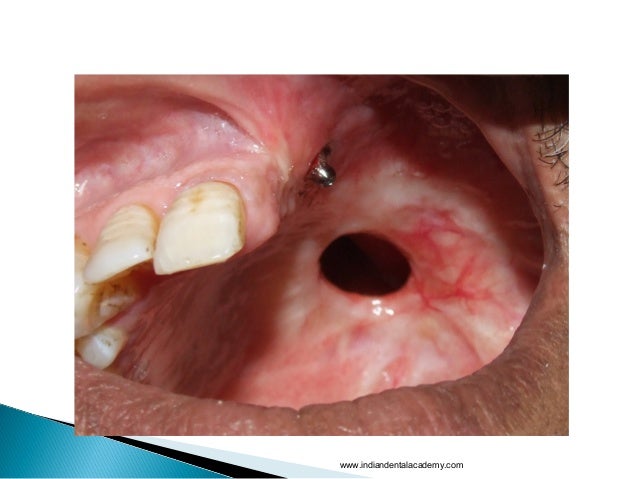 Recent prosthetic management of hemimaxillectomy /certified fixed ort…
