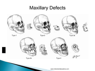 Recent prosthetic management of hemimaxillectomy /certified fixed ...
