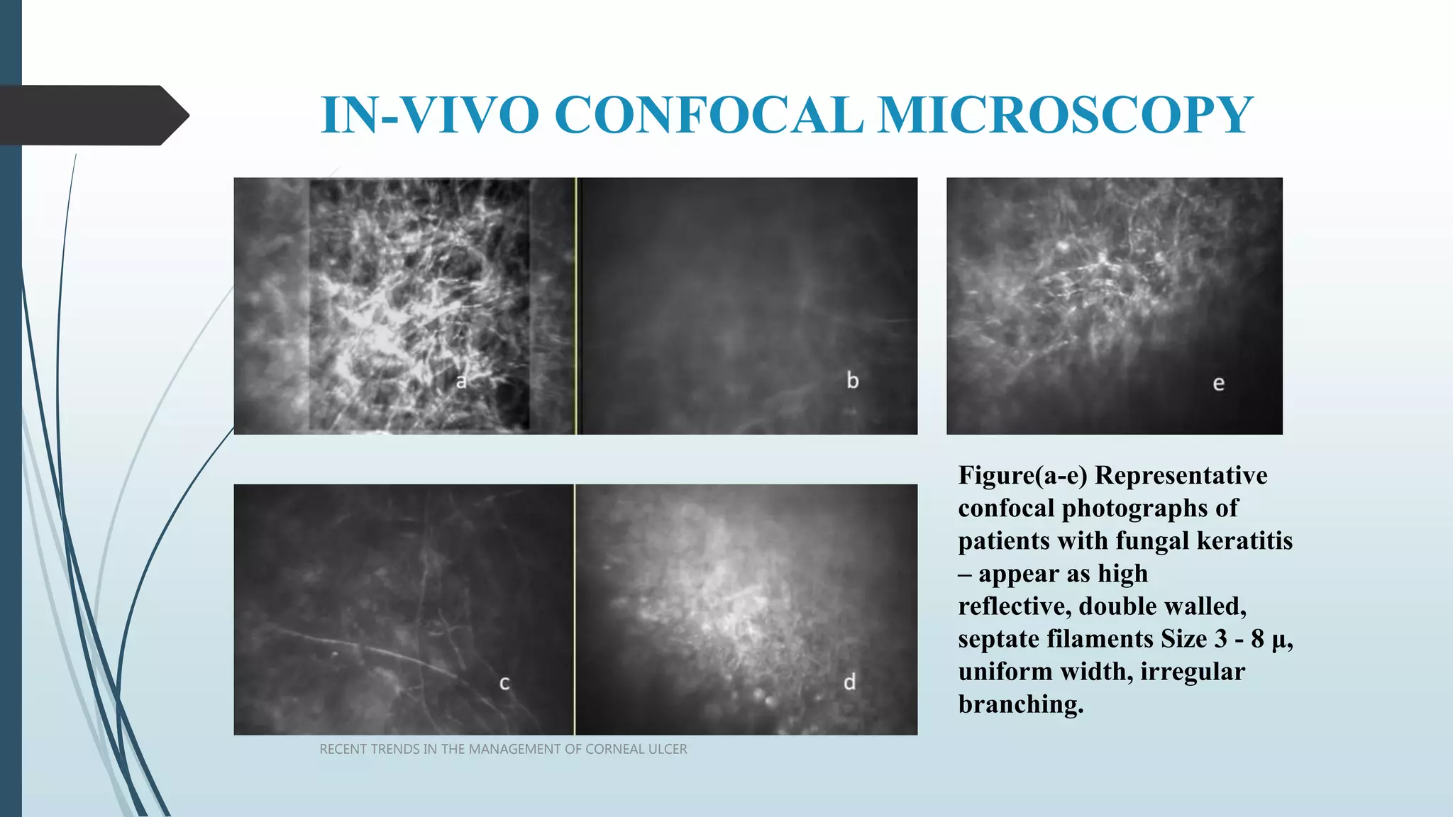 Recent trends in the management of corneal ulcer | PPTX