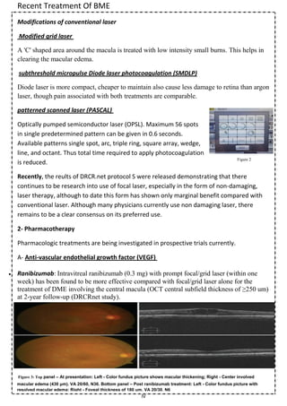 Recent Treatment of DME | PDF