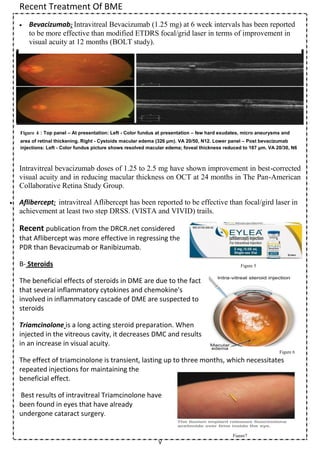 Recent Treatment of DME | PDF