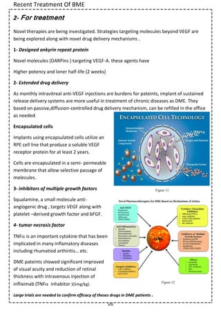 Recent Treatment of DME | PDF
