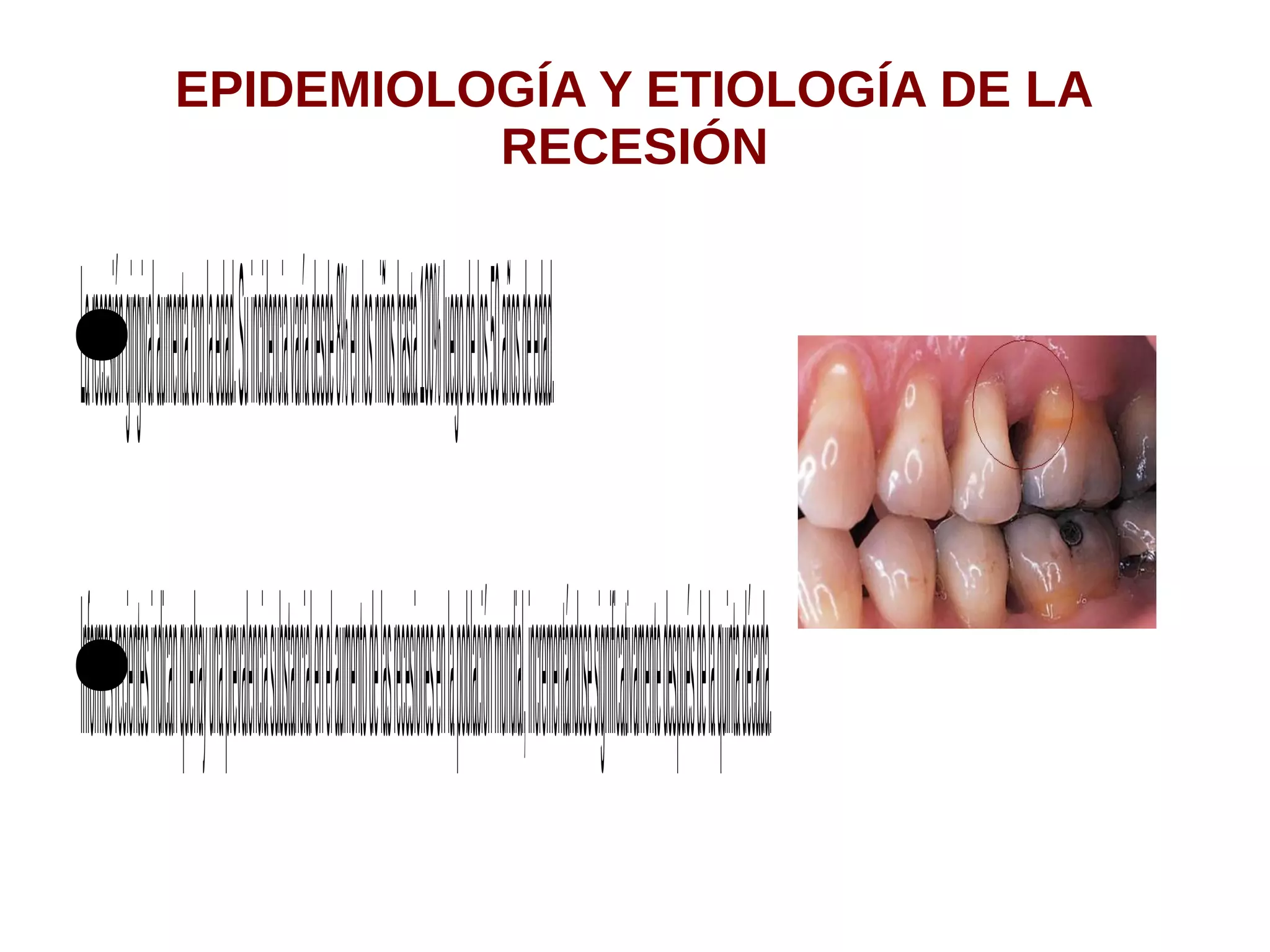 Recesion gingival | ODP