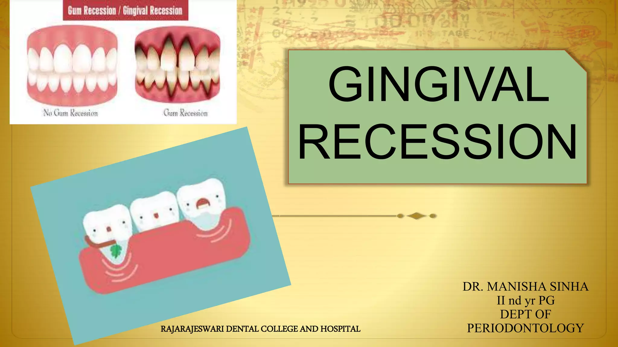 Gingival Recession | PPTX
