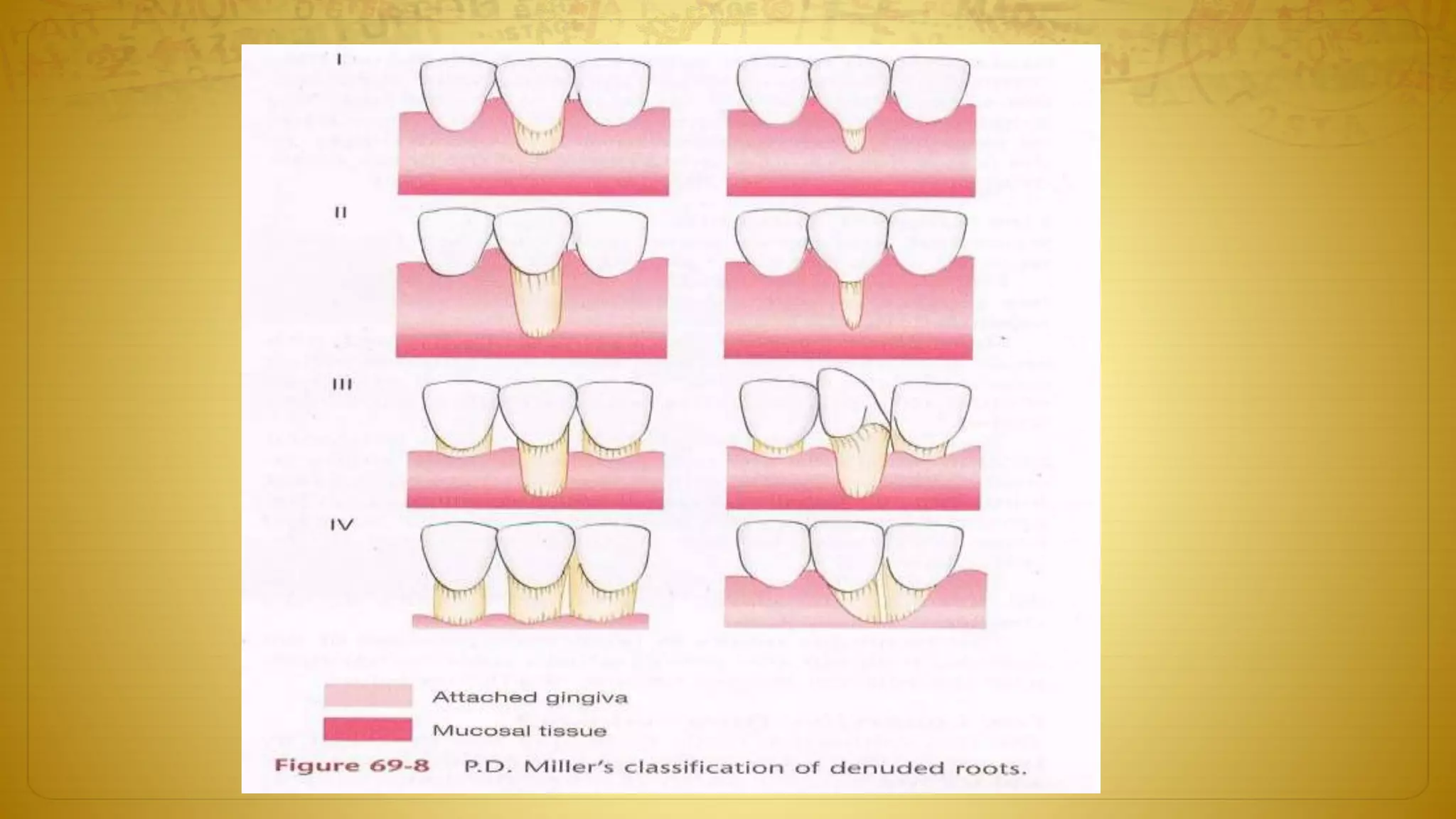 Gingival Recession | PPTX