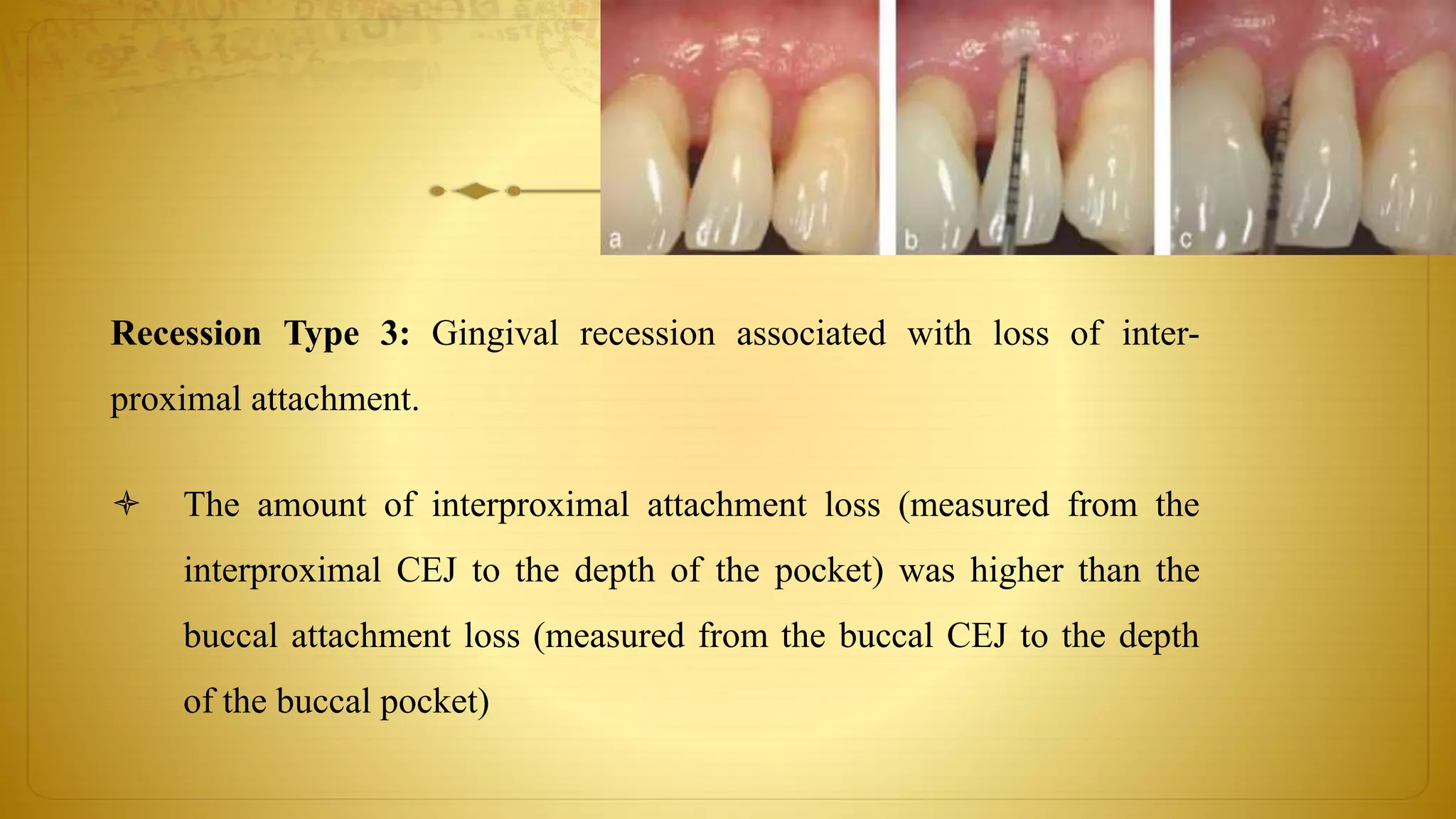 Gingival Recession | PPTX