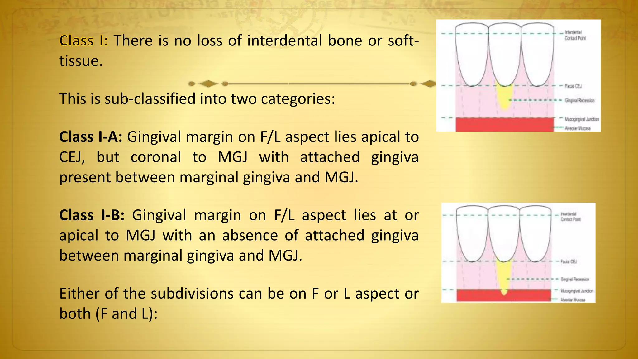 Gingival Recession | PPTX