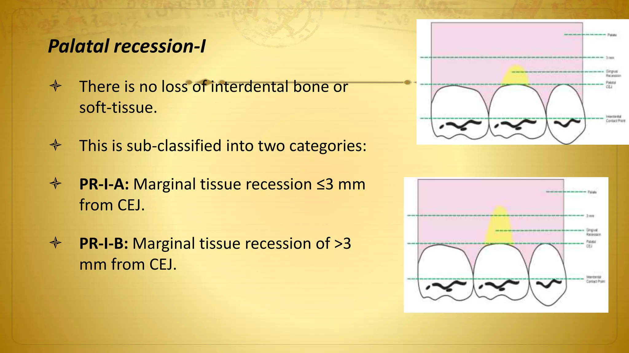 Gingival Recession | PPTX
