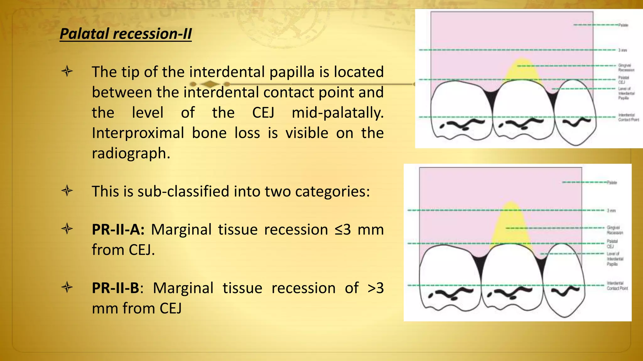 Gingival Recession | PPTX