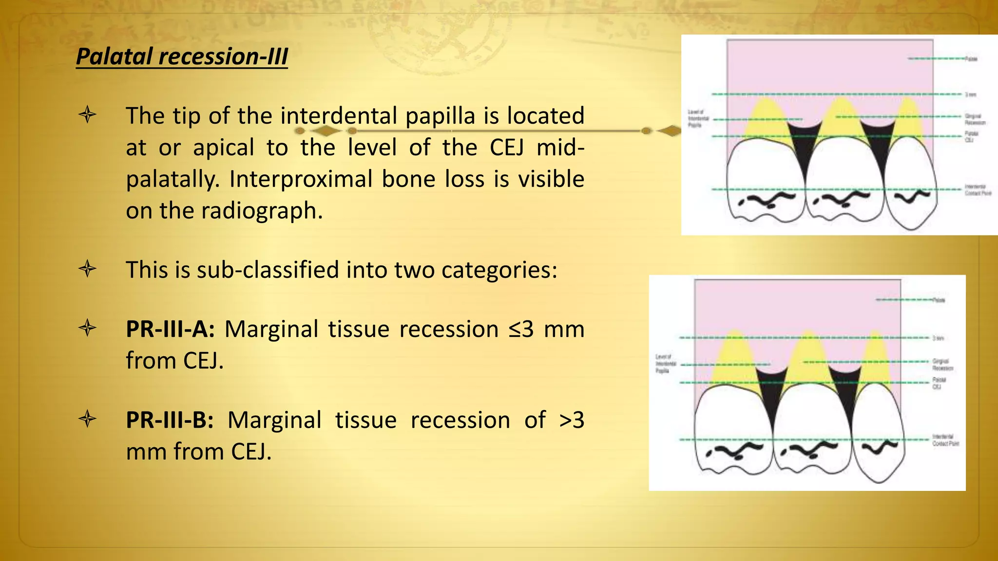 Gingival Recession | PPTX
