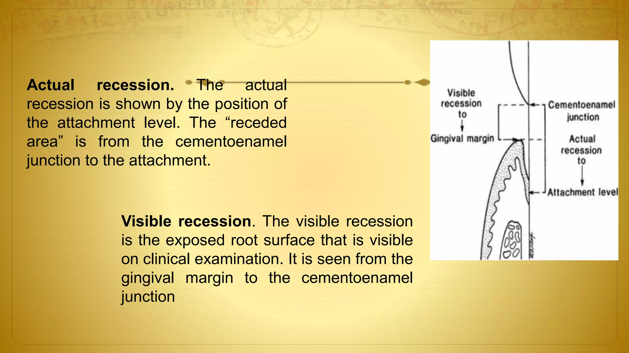 Gingival Recession | PPTX