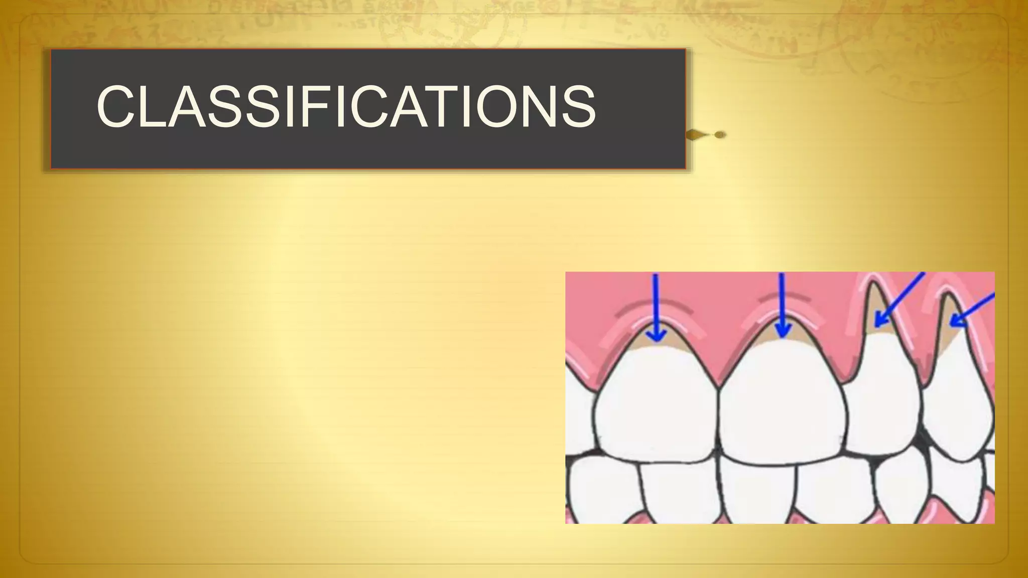 Gingival Recession | PPTX