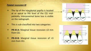 Gingival Recession | PPTX