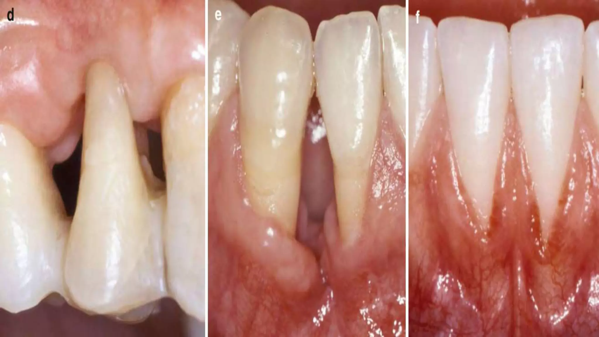 Gingival Recession type defects | PPT