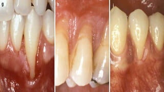 Gingival Recession type defects | PPT